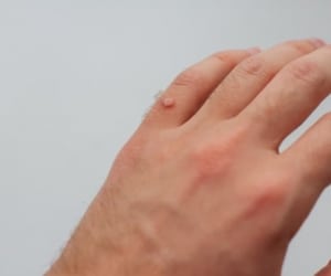 الثالول|علاج منزلي فوري